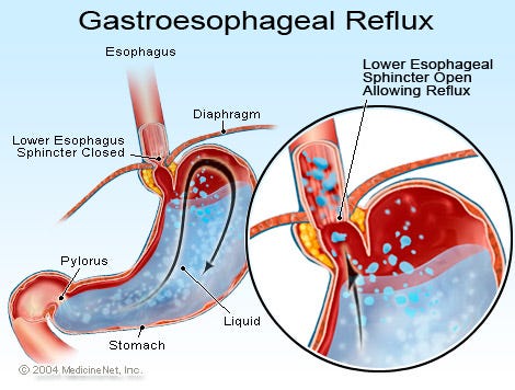 What is Acid Reflux? — Causes, Symptoms and Treatment | by Atul saini ...