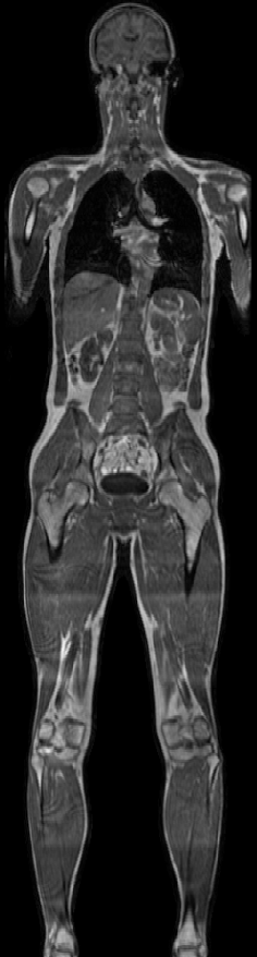 X Ray Body Fat