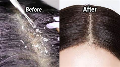 How To Way Dandruff From Hair - Khaliqdad - Medium