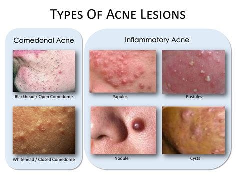 The Different Types of Acne and How to Treat Them | by Kelon Nyanguno ...