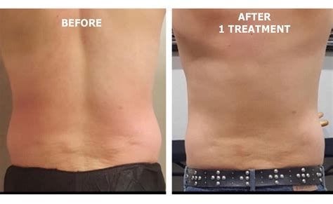 Best Liposuction In Islamabad. Struggling to shed stubborn fat from ...