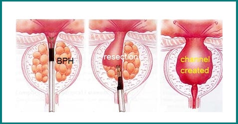 Bipolar TURP (Transurethral Resection of Prostate) — AUM | by Varmasid ...