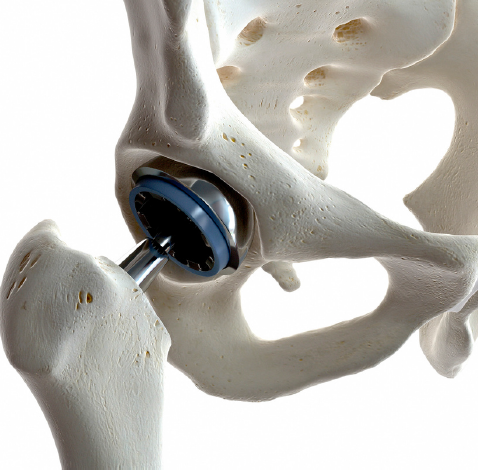 Ceramic vs. Metal Implants: Which Is Best for Active Patients? | by ...