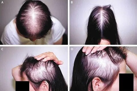 Causes of Hair Loss Issues: Understanding the Root of the Problem | by ...