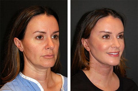 Mini Facelift for Sagging Skin. Sagging skin is one of the main… | by ...