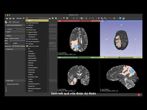 3D Slicer: An Extension for Brain Tumor Segmentation. | by Sho | Medium