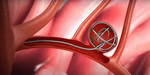 Vascular Embolization A Minimally Invasive Procedure for Blocking Blood ...