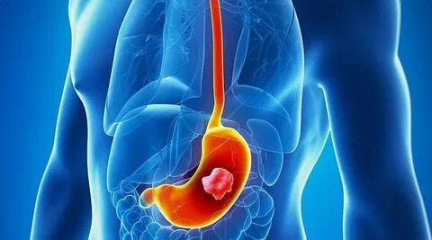 Paracentesis is the most common method in malignant ascites treatment ...