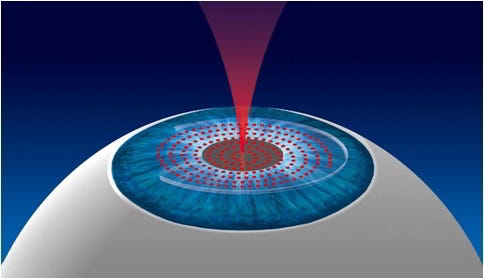 How Does Lasik Eye Surgical Procedure Work? | by manhattanlasikcenter ...