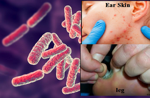 How to know Pseudomonas Infections? ? What are its main signs and ...