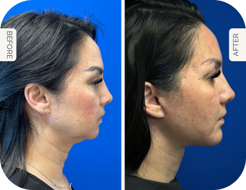 Transform Your Look: The Complete Guide to Face Lift Procedures | by ...