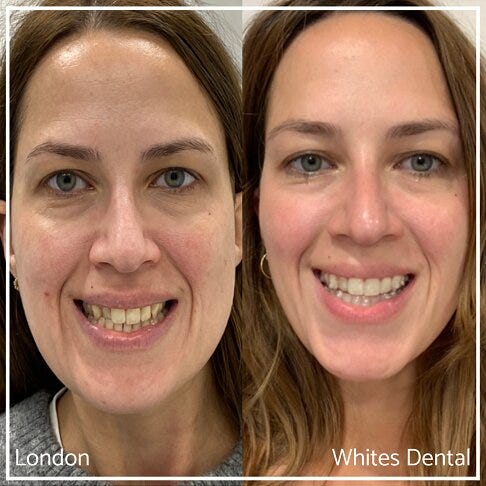 Everything You Need to Know About Invisalign Prices UK | by ...