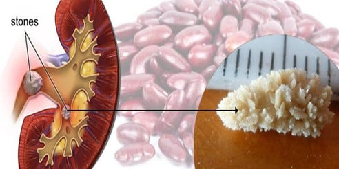 3 Advantages of laser Treatment For Kidney Stones | by Dr. Naresh Kumar Garg | May, 2024 | Medium
