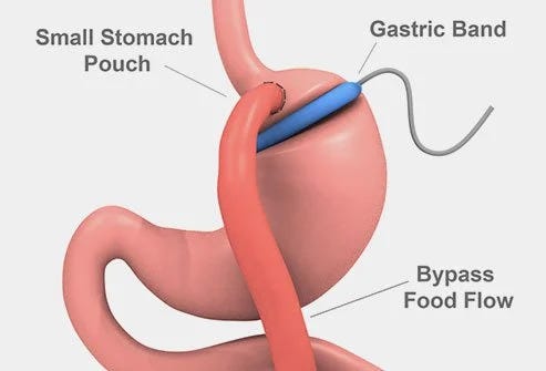 Gastric banding surgery And Procedure | by Hazel Beach | Medium