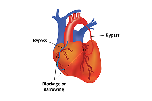 Know About Open Heart Surgery-Best Cardiac Surgeon In Bhopal | by ...