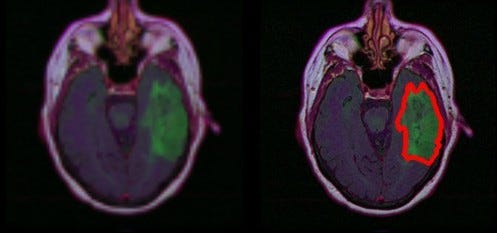 Brain Tumor Segmentation using Pyramid Scene Parsing (PSPNet) | by ...