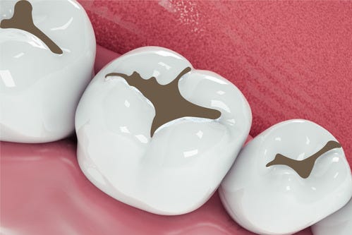 Tooth Colour Filling Advantages And User Guide | by Mosol9 | Feb, 2024 ...