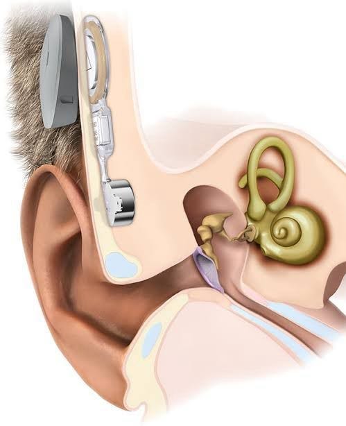 Understanding Bone-Conduction Hearing Aids and BAHA | by ...