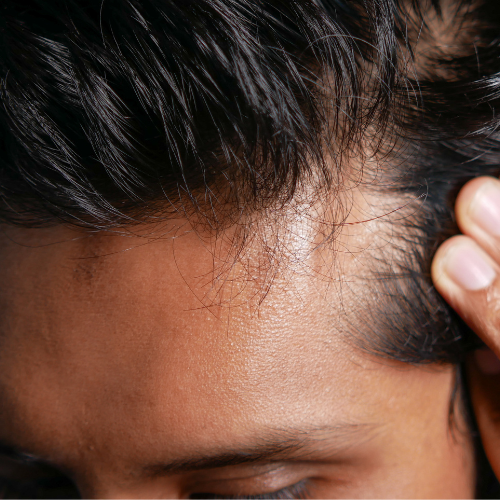 Understanding PRP for Hair Growth | by Better Health Medical Center ...