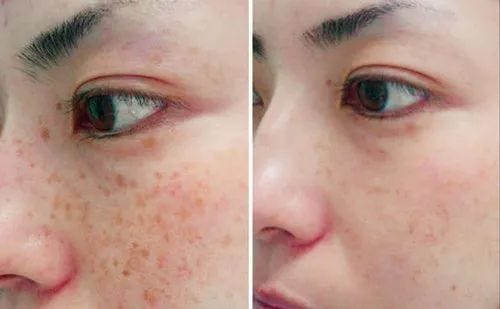 Pigmentation Laser Treatment Before and After | by midasaesthetics | Medium