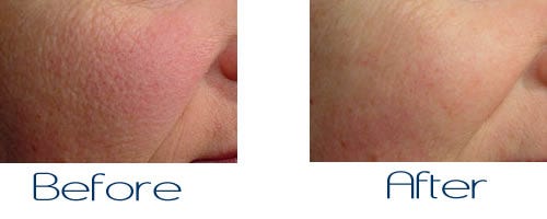 Tips for Treating Large Pores. We all want satiny smooth skin… | by ...