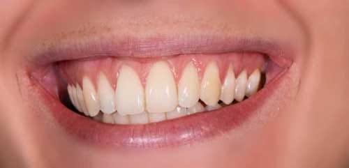 How To Reverse Receding Gums Naturally At Home? | by Roger Smith | Medium