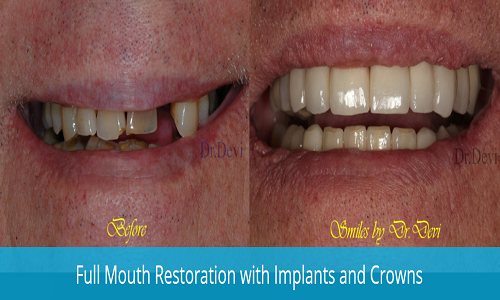 Repair Your Damaged Denture with High Level of Security | by Ryan ...