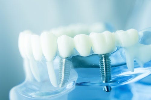 REDISCOVERING YOUR SMILE: A COMPREHENSIVE GUIDE TO DENTAL IMPLANTS AT ...