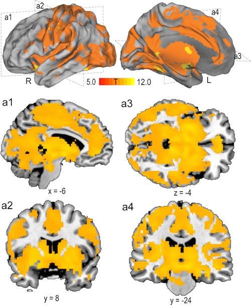 Anxiety and your amygdala. The amygdala is an almond-shaped set of ...