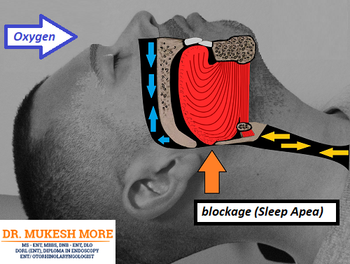 What is the root cause of snoring and how can anyone decrease it? | by ...