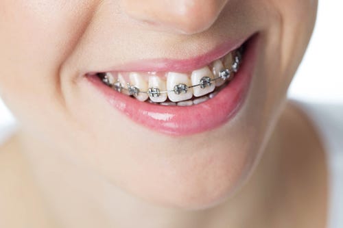 Teeth in Motion: The Daily Magic of Braces in Dubai | by anaya george ...