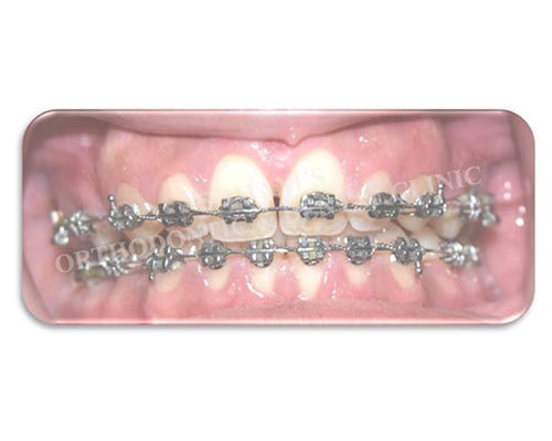 Orthodontic Treatment | Ceramic, Metal, Invisalign, Invisible, Lingual ...