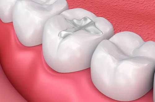 Recommended Dental Fillings In Lawrenceville, GA - Carla Grayson - Medium