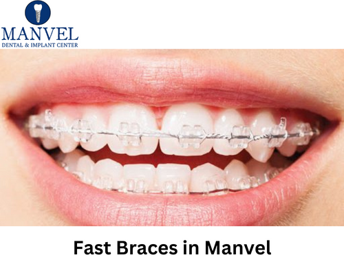 Fast Braces in Manvel — Manvel Dental & Implant Center | by Manvel ...
