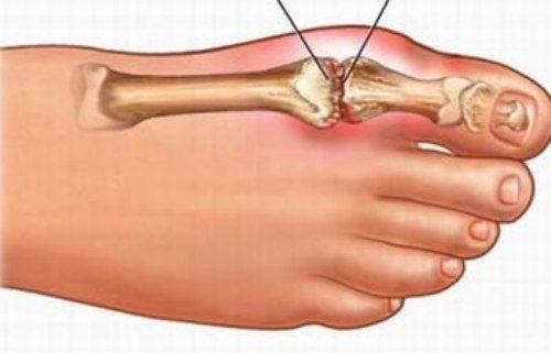 The First Line Treatment of Gout. Recent study aimed at assessing the ...