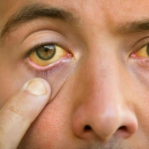 High cholesterol: Your face can tell about your lipid profile; 4 ...