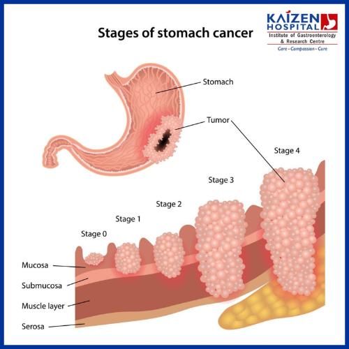 What are the 3 symptoms of stomach cancer? - Kaizen Hospital - Medium