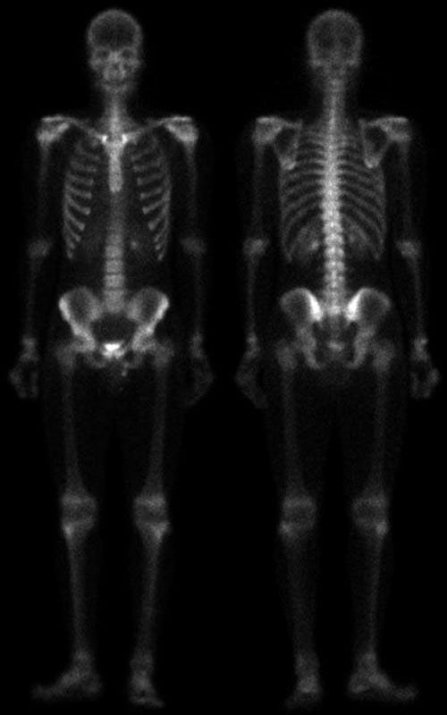Enhancement Of A Low Quality Whole Body Bone Scan Image By Enhancement Of A Low Quality Whole Body Bone Scan Image By