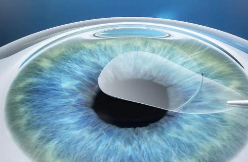 What is SMILE Eye Surgery ?. A Look at SMILE Eye Surgery | by Sanika ...