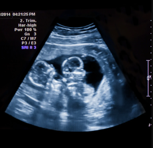World TTTS Awareness Day. This month is a time to raise awareness… | by ...