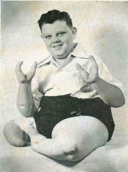 Lobster Boy Grady Stiles