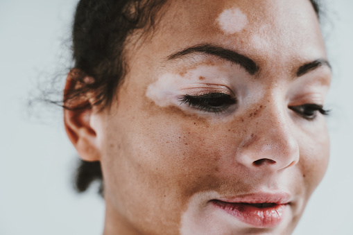 Treatment For White Patches On FaceUnveiling Radiance: Effective ...