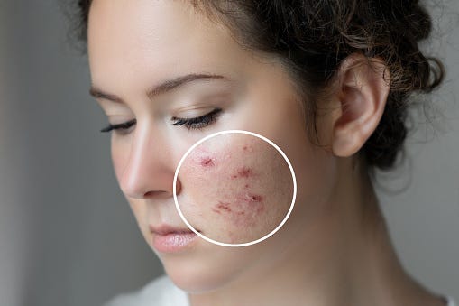 10+ Proven Tips On How To Get Acne Free Clear Skin | by Sharafnaqvi ...