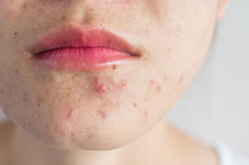 Inflamed acne: Causes, symptoms, and remedies | by Alex Agnes | Medium