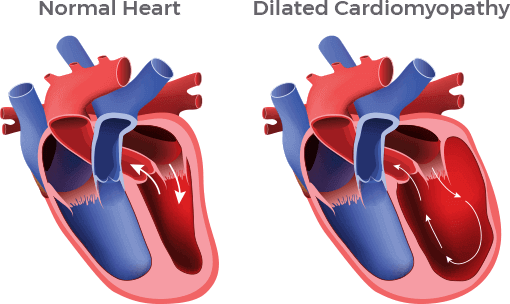 Cardiomyopathy- 2. Dilated Cardiomyopathy. | by Janitha Anuhas | Medium