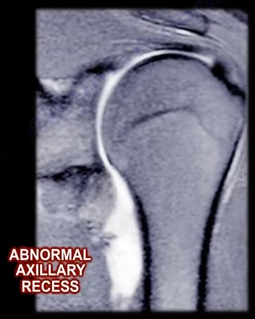 Hagl Lesion Is Only A Fixed By Surgery