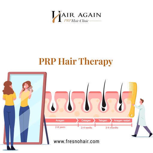 How PRP Hair Therapy Works: Your Questions Answered | by Fresnohair ...