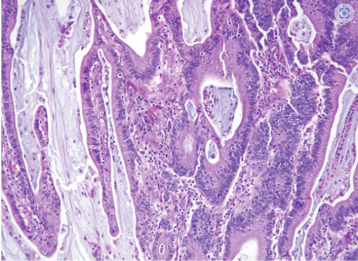 Introduction to Lynch (Hereditary Non-polyposis Colon Cancer) Syndrome ...