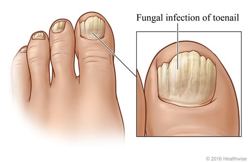 REAL cause of Toenail fungus revealed and How to Eliminate it in less ...