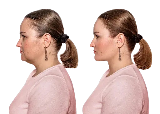 How To Get Rid Of Jowls: From Saggy To Splendid — Your Step-By-Step ...